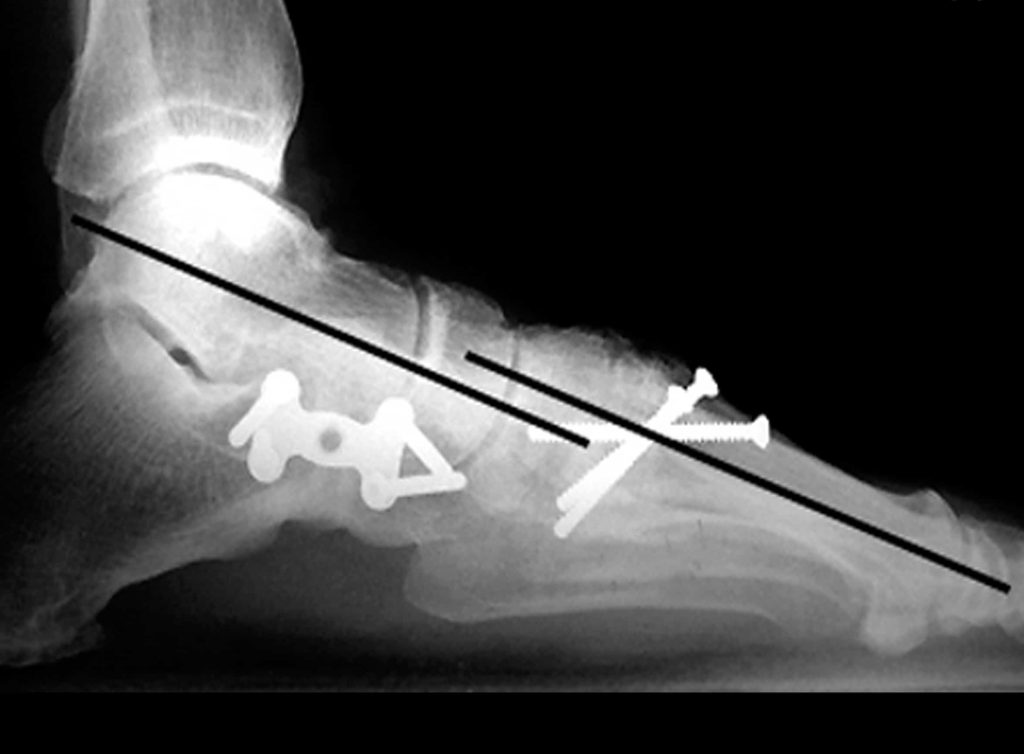 HyProCure Surgery in Lake Charles, LA | Louisiana Foot & Ankle Specialists